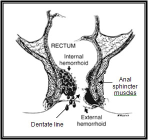 Hemorrhoidectomy | UCSF Kratz Lab